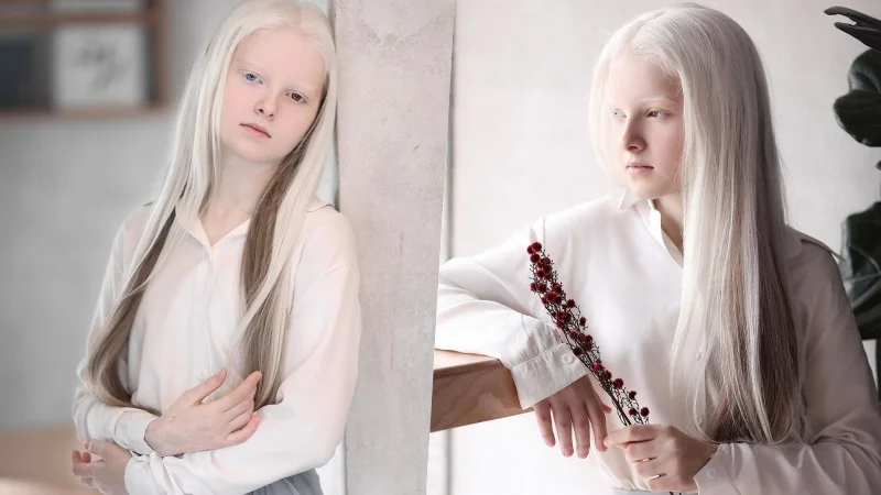 Albino Gak Membuatnya Minder, Gadis Ini Curi Perhatian Karena Kecantikannya